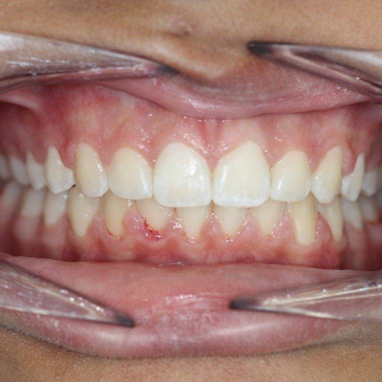 Upper and lower crowding of teeth with large overbite and Narrow arches ...