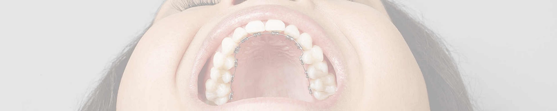 Eatment Of Large Overjet And Overbite Case Treated By Dr Anand Align