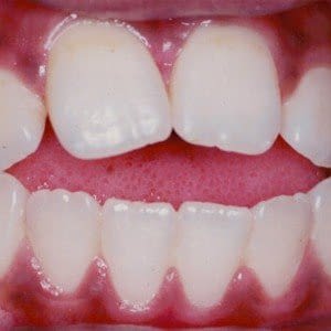 Anterior Open bite, How do parents recognise it ? Align Dentistry Blog