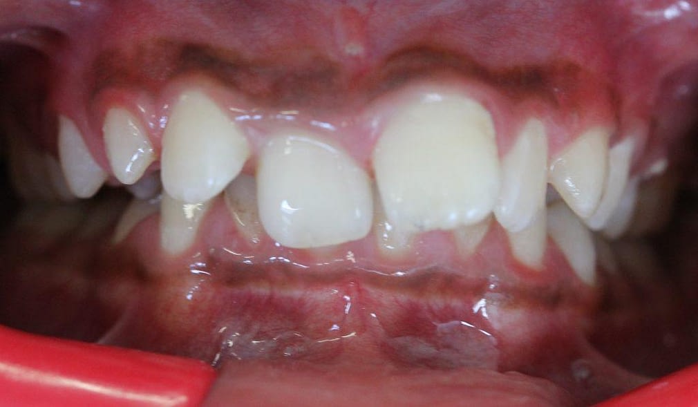 Eatment Of Large Overjet And Overbite Case Treated By Dr Anand Align