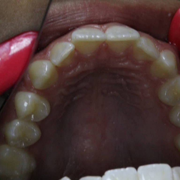 Upper and lower crowding of teeth with large overbite and Narrow arches ...