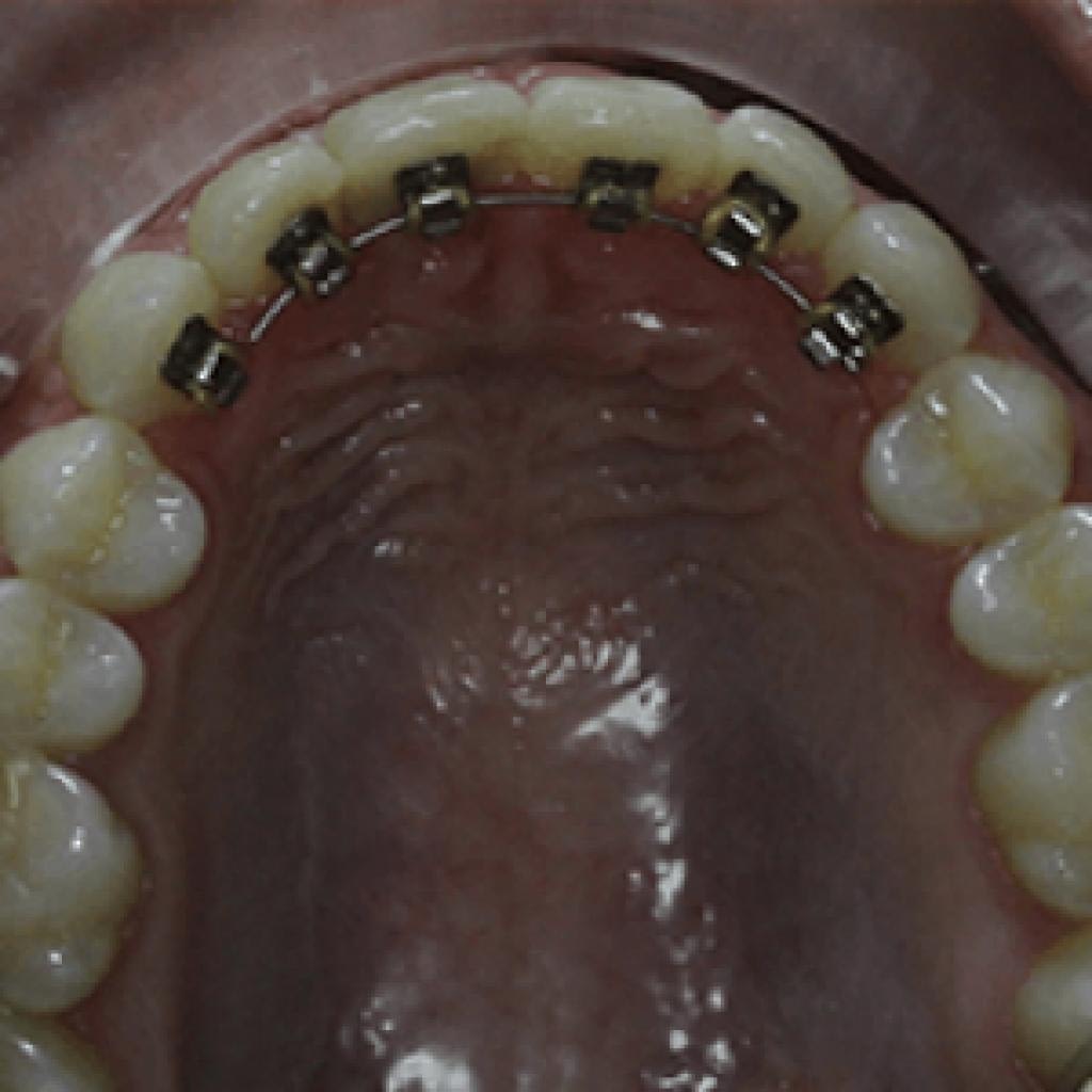 Lingual Braces Braces Behind The Teeth Align Dentistry And Medical Centre