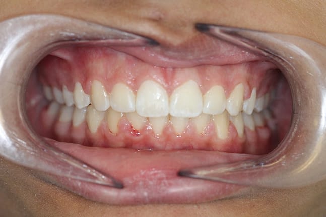 Narrow arch Results in Crowding and a Narrow Smile - Align Dentistry