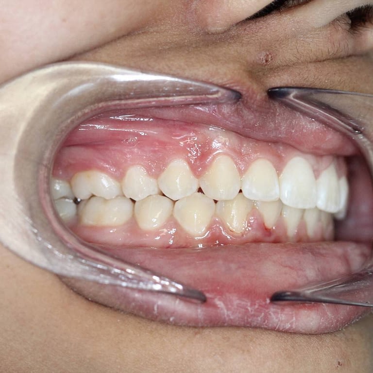 Upper And Lower Crowding Of Teeth With Large Overbite And Narrow Arches