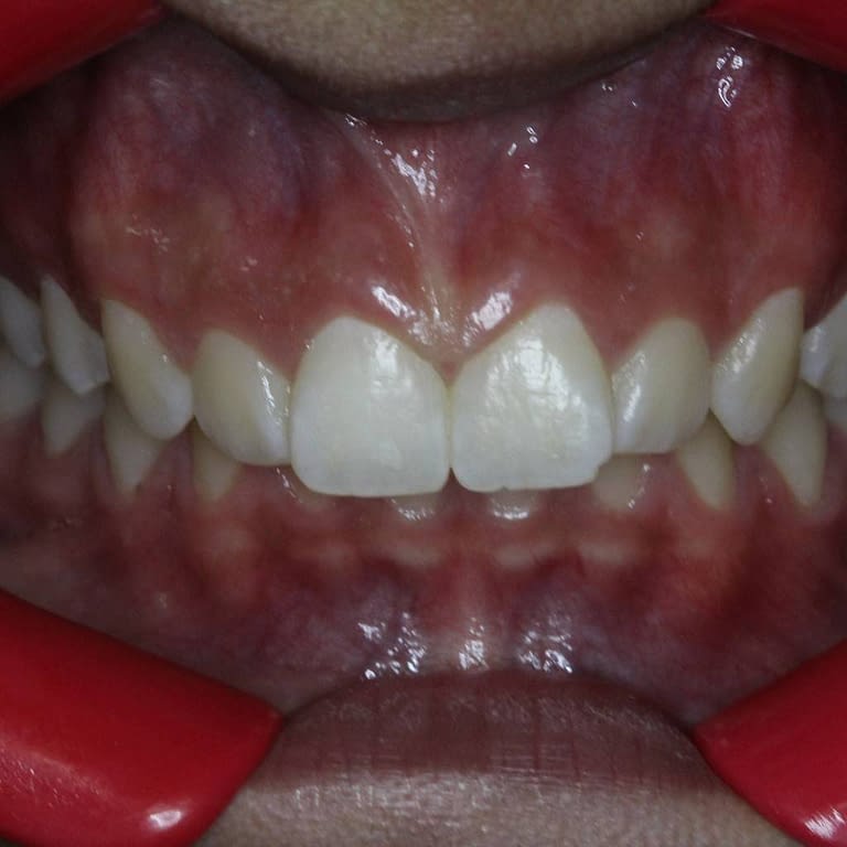 Upper and lower crowding of teeth with large overbite and Narrow arches ...