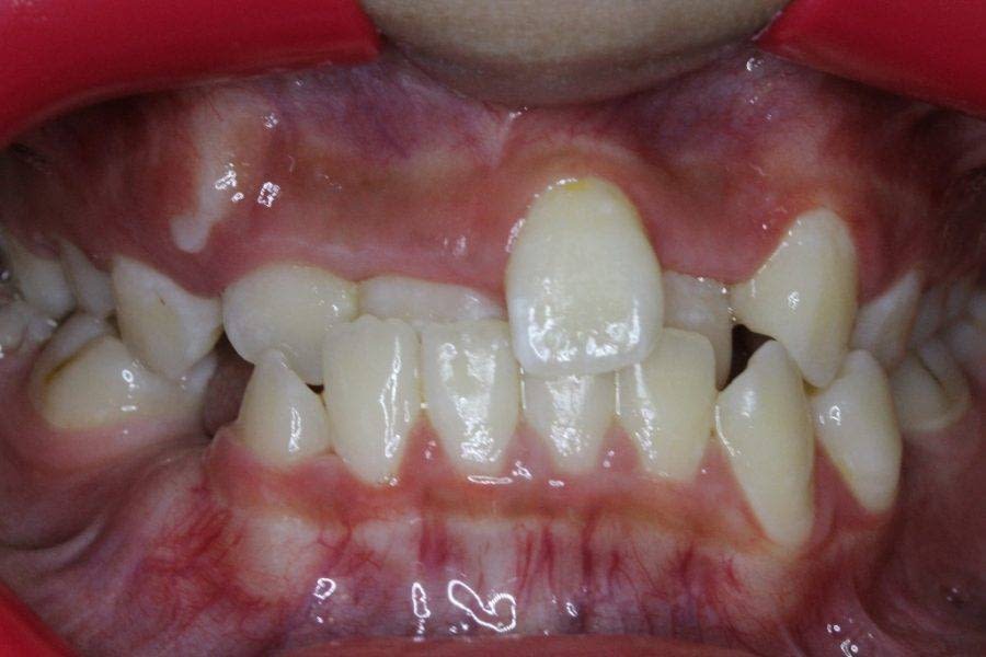 Improper Overbite and its correction, Align Dentistry Blog